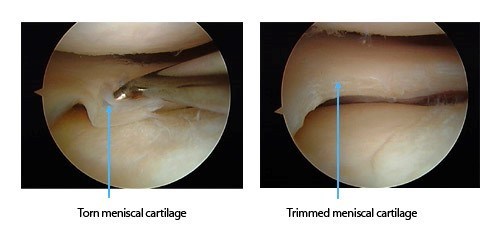 Meniscus Tear - Masters Orthopedic Care and Sports Medicine